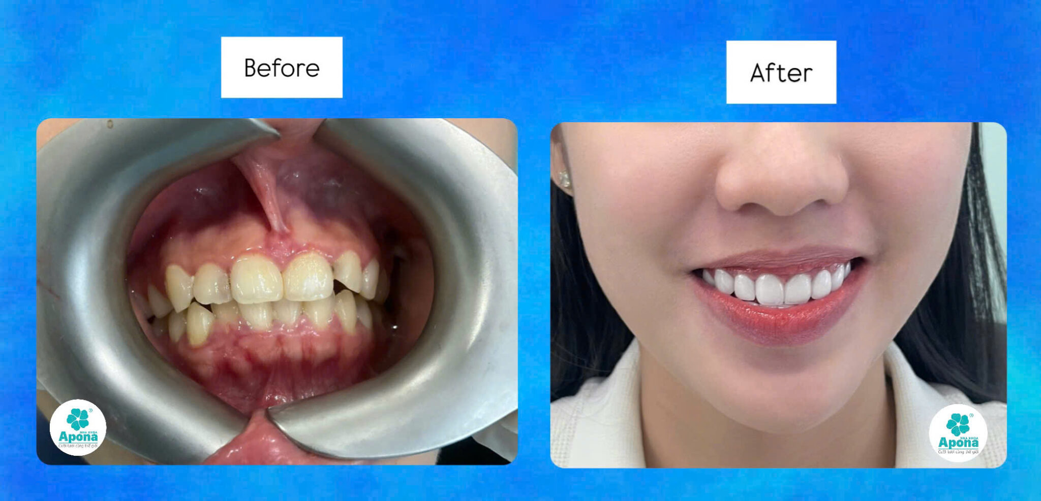 HOÀN THÀNH CA 20 RĂNG SỨ VITA CHO BẠN KHÁCH NỮ XINH ĐẸP TẠI NHA KHOA ...